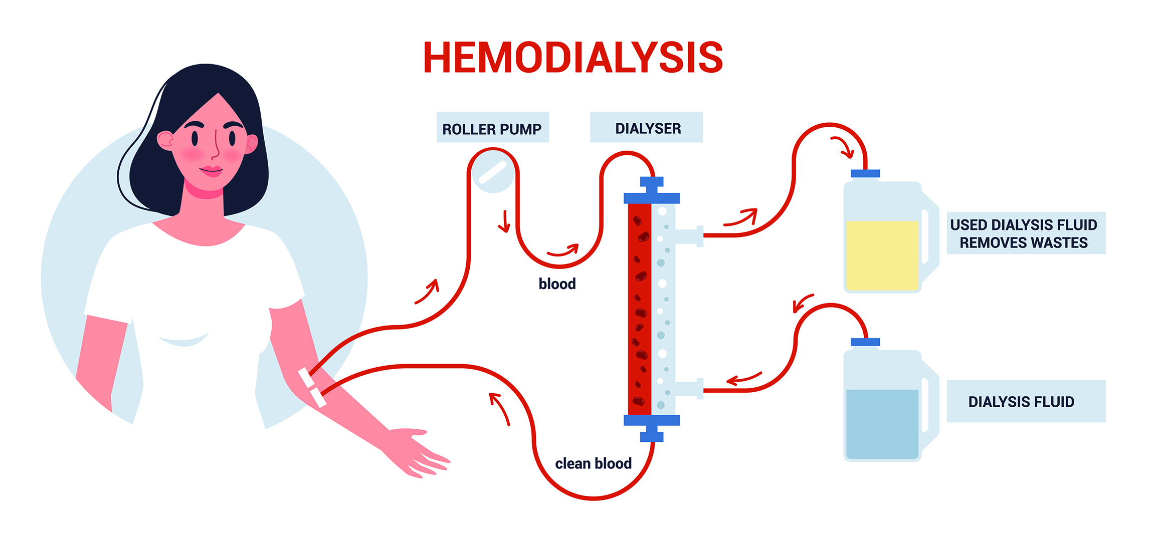 Hemodialysis - DR. PALLAVI PATRI